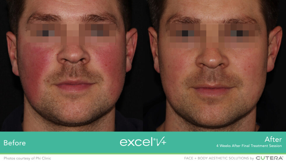 Excel V+ | Buffalo, NY | Healthy Complexions Spa